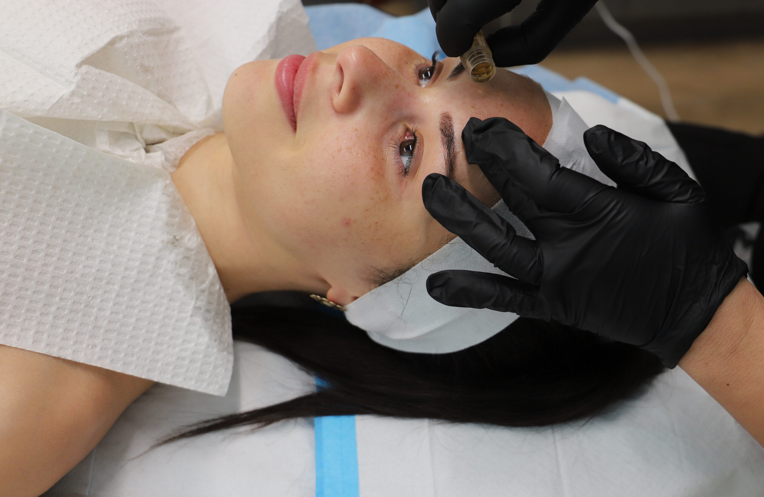 What is a PRP Facial? | My Experience + Before and After - IsabelxMarie