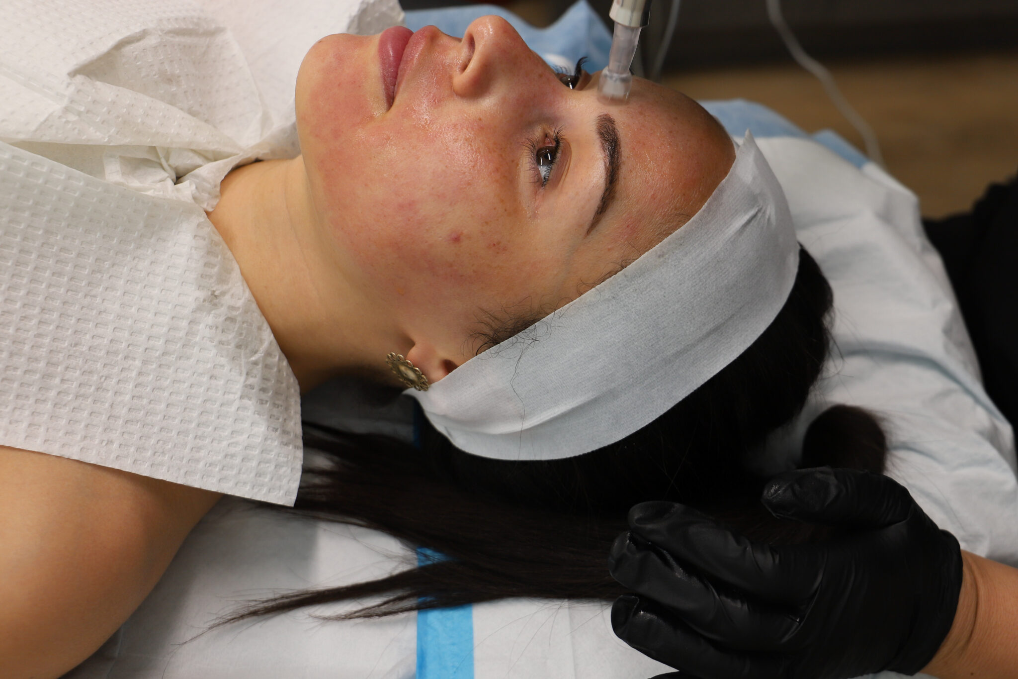 What is a PRP Facial? | My Experience + Before and After - IsabelxMarie