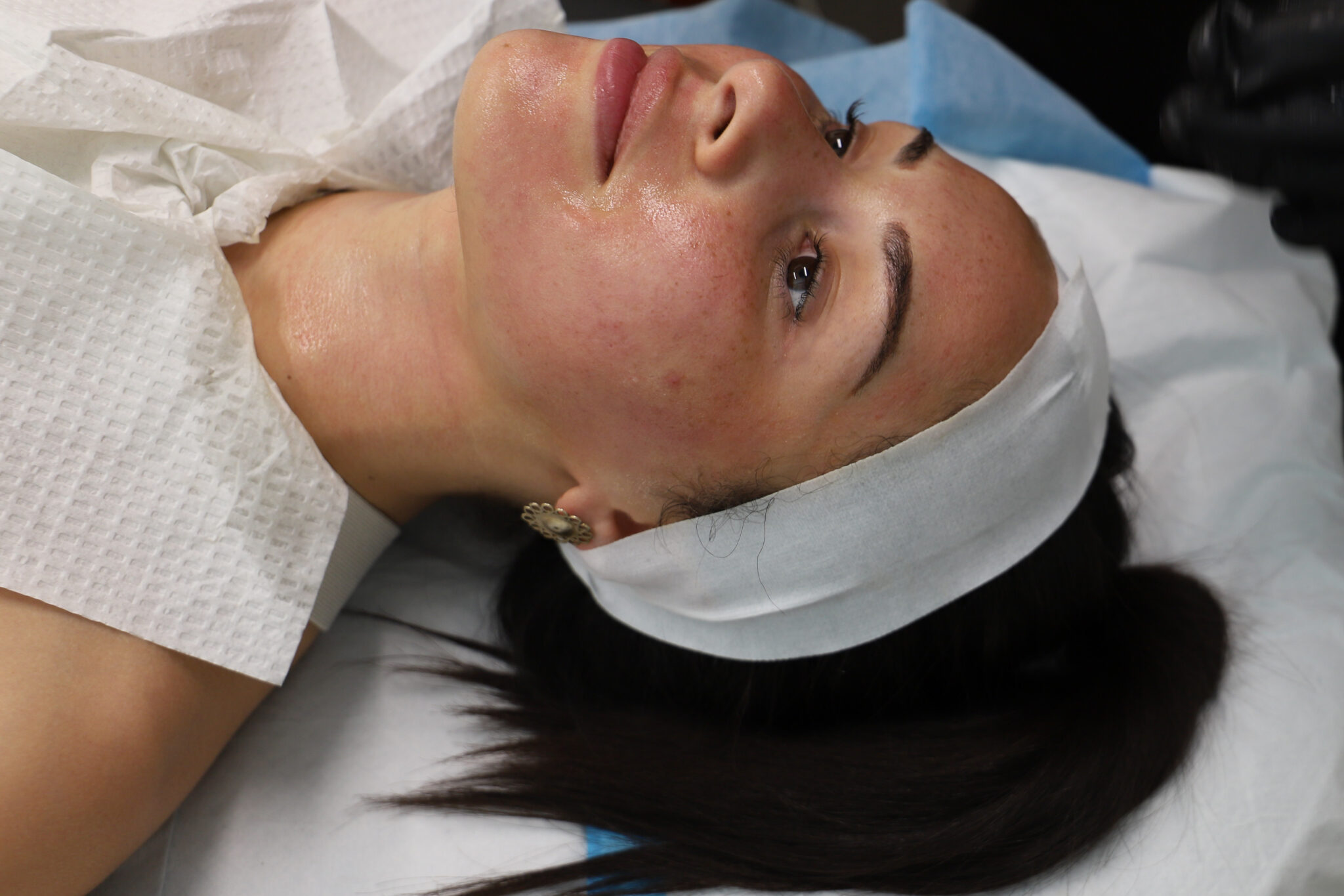What is a PRP Facial? | My Experience + Before and After - IsabelxMarie