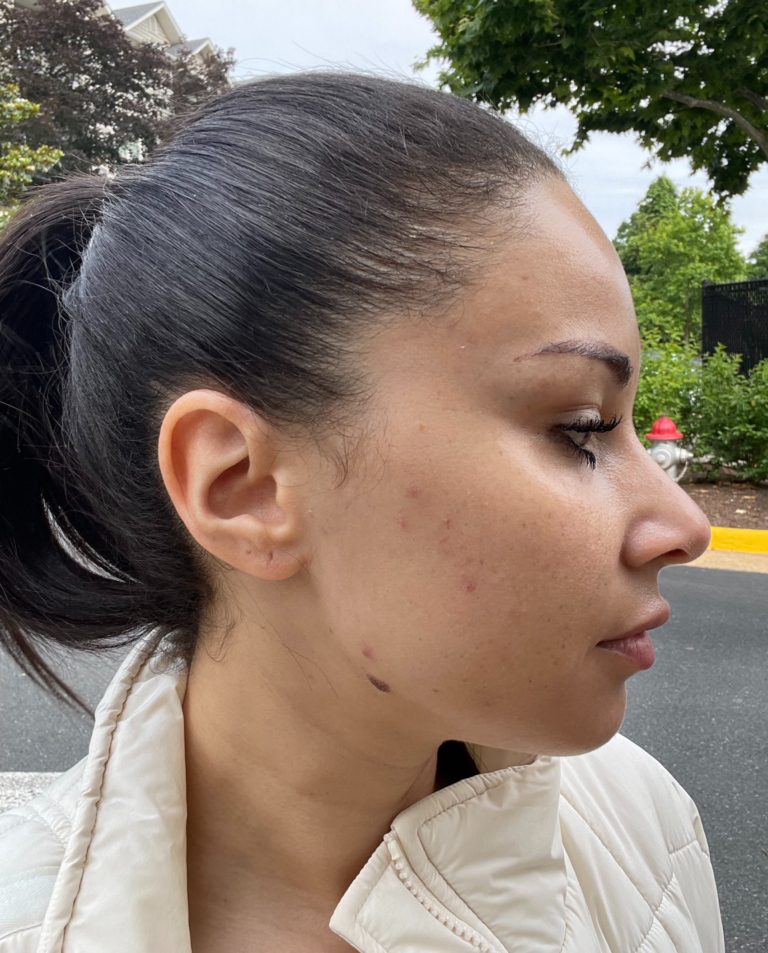 Unlocking Radiant Skin: What is the SaltFacial Treatment?